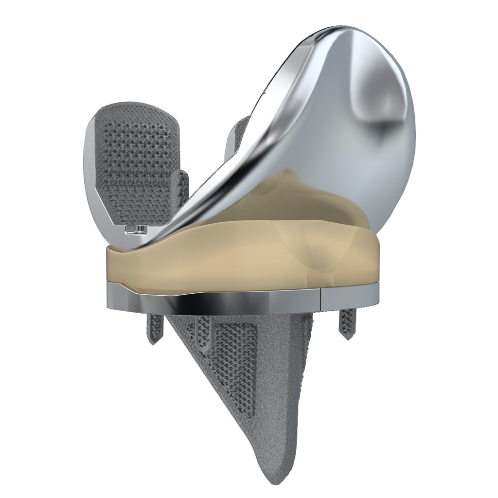 A Pivot Forward: Uncemented Medial Pivot Knee & Robotic TKR